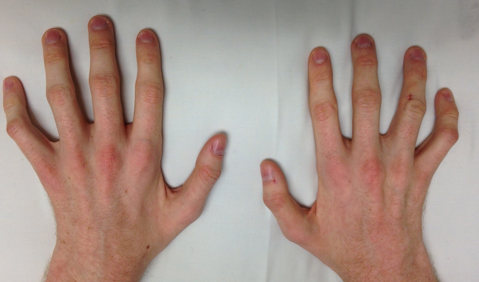 Charcot Marie Tooth | The Bone School