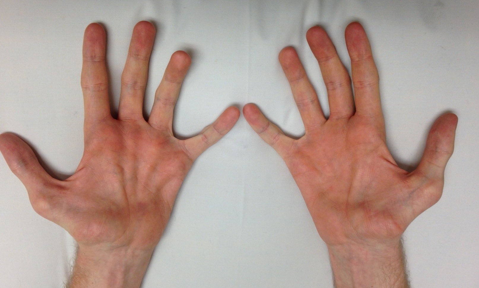 Charcot Marie Tooth | The Bone School