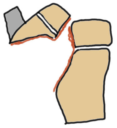 Tibial tubercle fractures | The Bone School