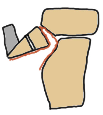 Tibial tubercle fractures | The Bone School