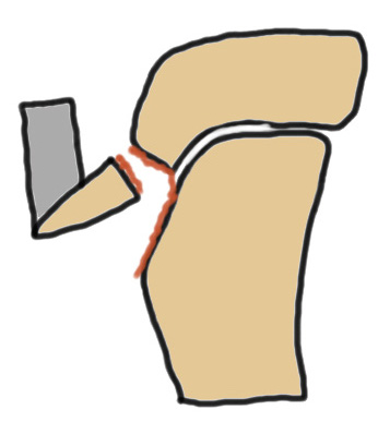 Tibial tubercle fractures | The Bone School