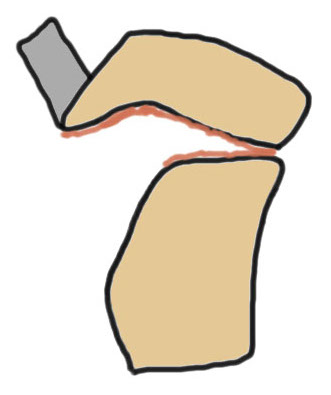 Tibial tubercle fractures | The Bone School