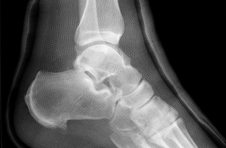 Talar Neck Fracture | The Bone School