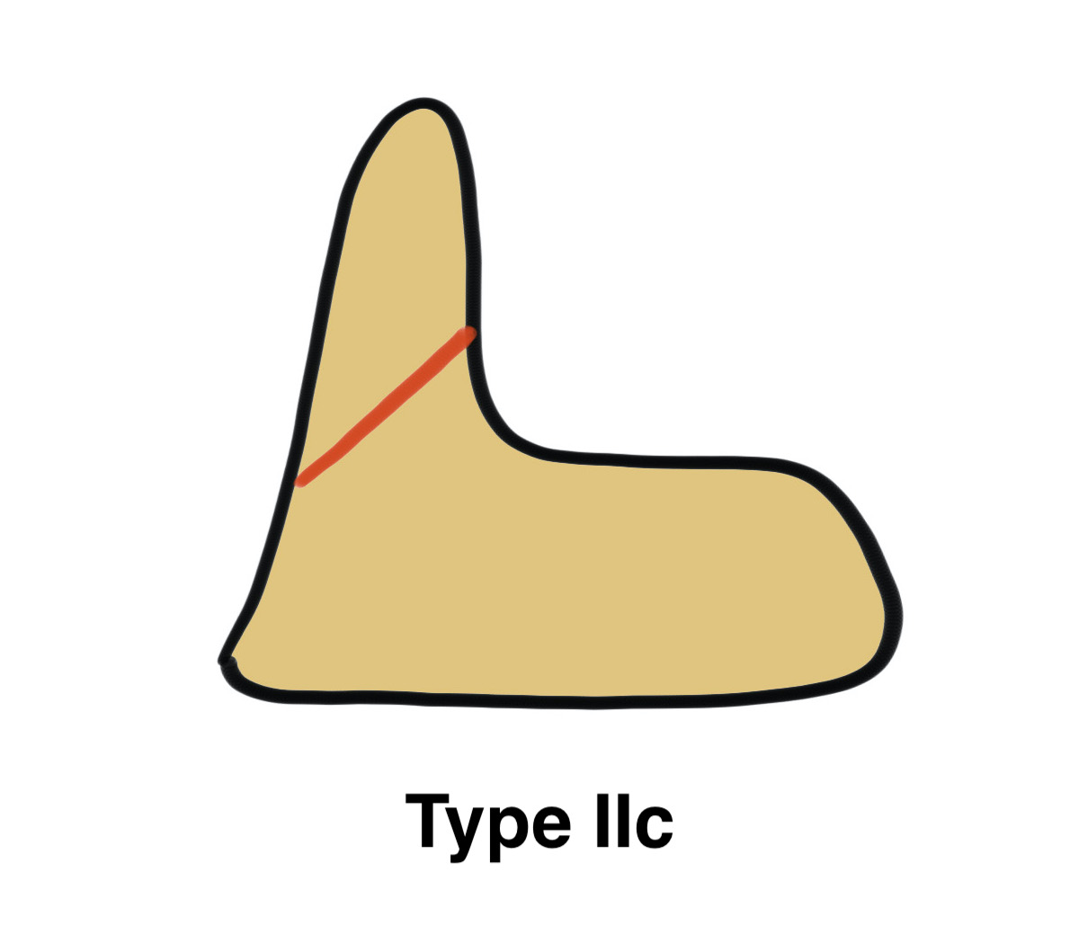 Dens / Odontoid Fracture | The Bone School