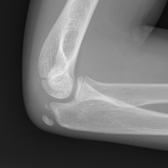 Centers of Ossification | The Bone School