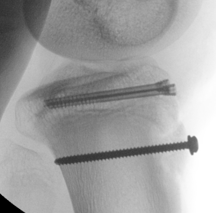 Tibial tubercle fractures | The Bone School