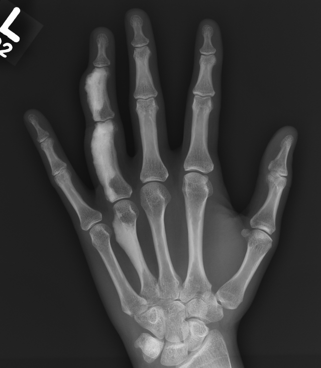 Melorheostosis | The Bone School