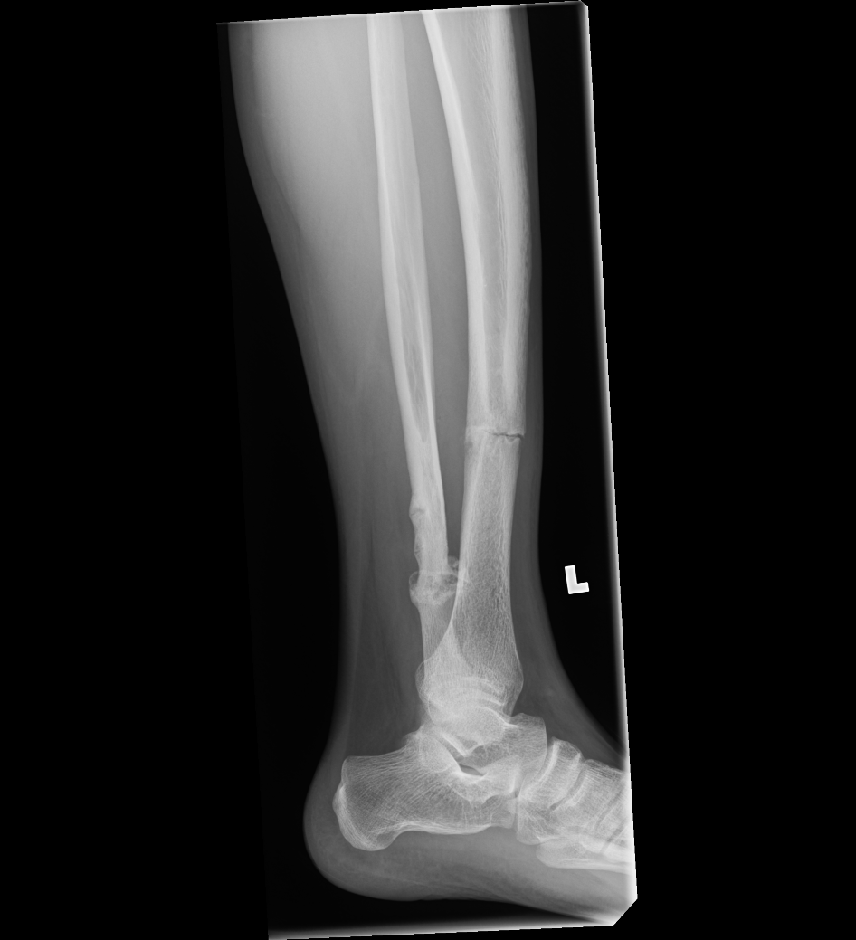 Tibial Stress Fractures | The Bone School