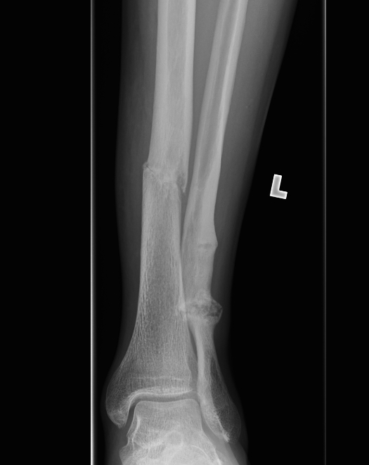 Stress Fracture X Ray Tibia